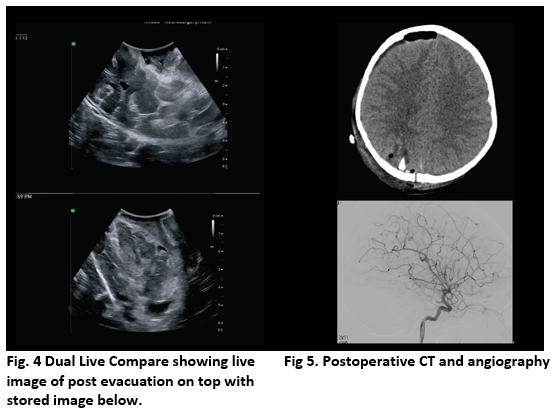Real-Time Active Imaging with Intraoperative Ultrasound for Hematoma ...