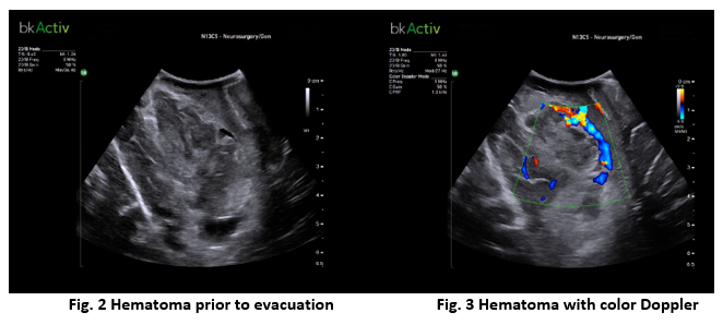 Real-Time Active Imaging with Intraoperative Ultrasound for Hematoma ...