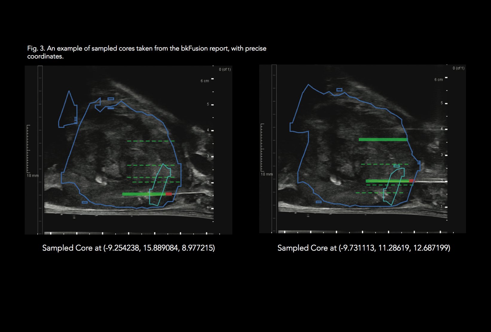 Case Study: A Transperineal Prostate Biopsy Procedure Performed with ...
