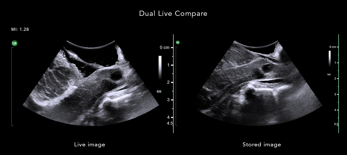 Intraoperative Imaging for Chiari Decompression: Case Study