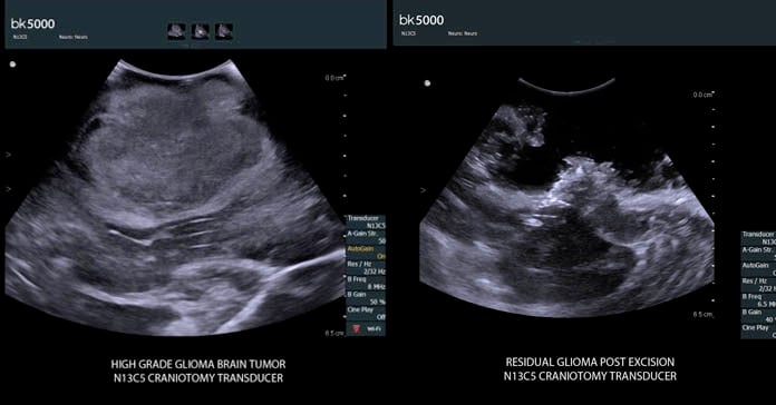Guiding Tumor Resections In Neurosurgery With Intraoperative Ultrasound Prof Geirmund Unsgård