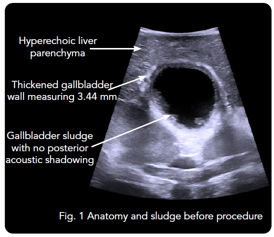 Safe, Real-Time Visualization in a Cholecystectomy Case with ...