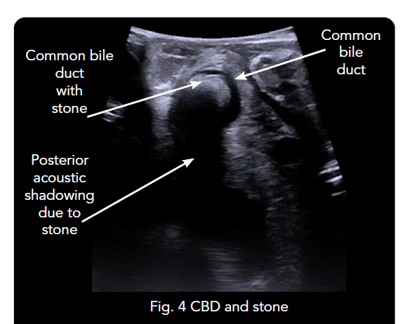 Safe, Real-Time Visualization in a Cholecystectomy Case with ...