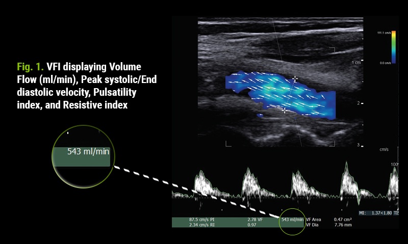 Vector Flow Imaging Case Study: Technology Developed for Clinical Impact